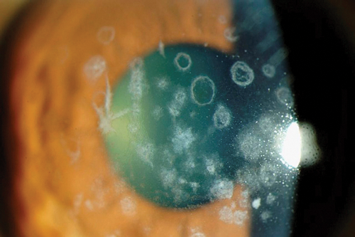 Corneal dystrophies simplified | Eye News