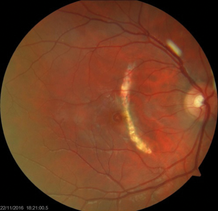 A log in the eye | Eye News