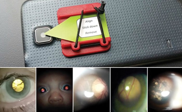 The Arclight: A ‘pocket’ ophthalmoscope to revitalise undergraduate ...