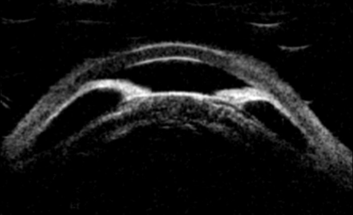 Ultrasound biomicroscopy (part 2): primary angle closure | Eye News