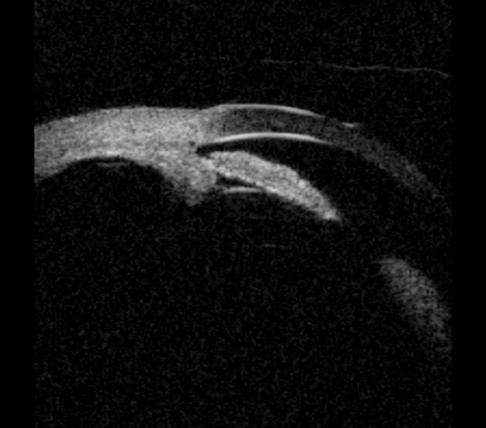 Ultrasound biomicroscopy (part 2): primary angle closure | Eye News