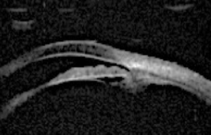 Ultrasound biomicroscopy (part 2): primary angle closure | Eye News
