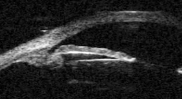 Ultrasound biomicroscopy (part 2): primary angle closure | Eye News