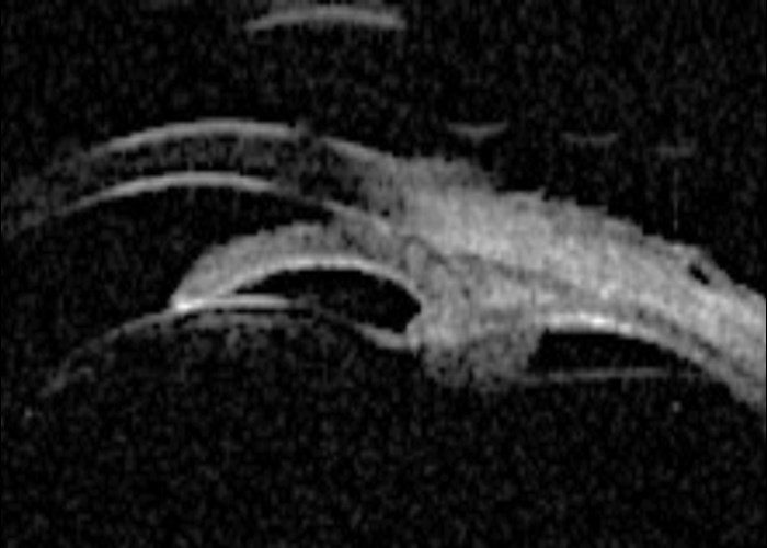 Ultrasound biomicroscopy (part 2): primary angle closure | Eye News