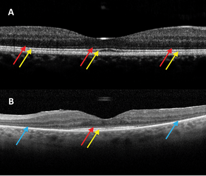 An update on inherited retinal disorders (part 1) – overview and ...