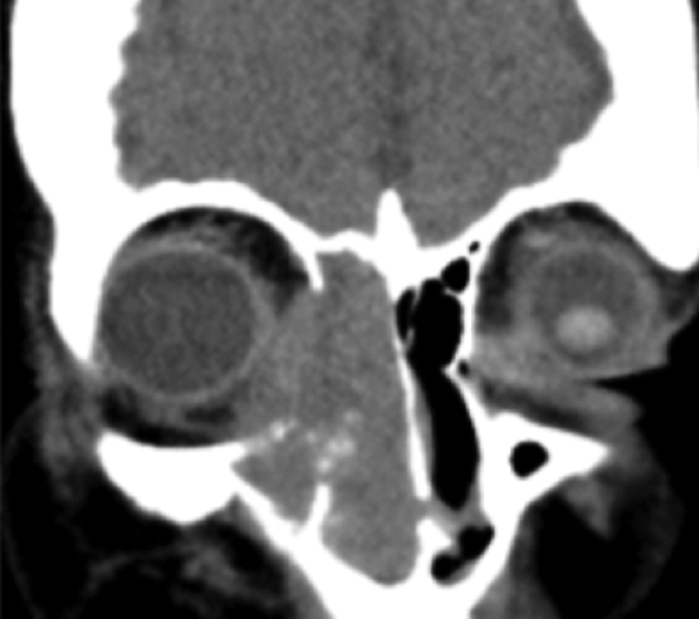 Chronic dacryocystitis? | Eye News
