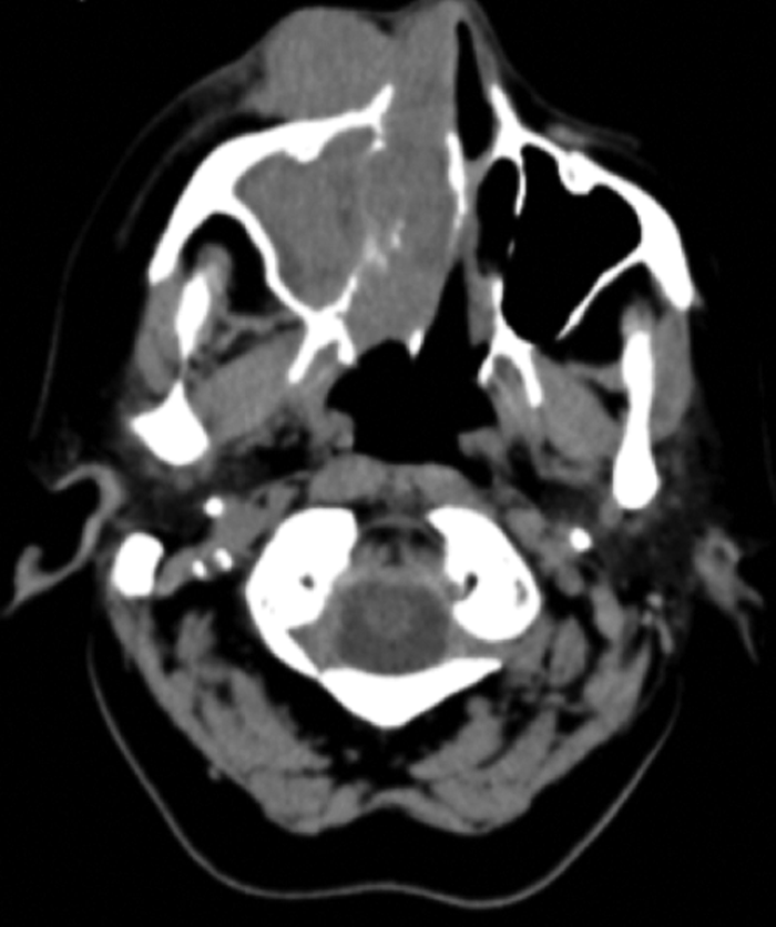 Chronic dacryocystitis? | Eye News