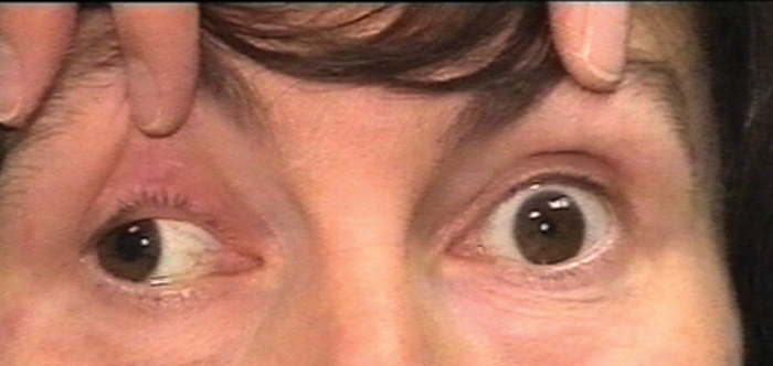 A practical guide to anisocoria | Eye News