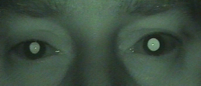 A practical guide to anisocoria | Eye News