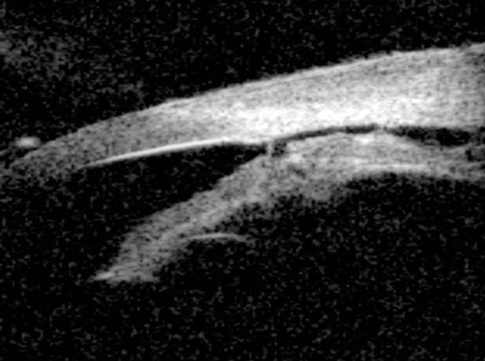 The interpretation and use of ultrasound biomicroscopy (part 1) | Eye News