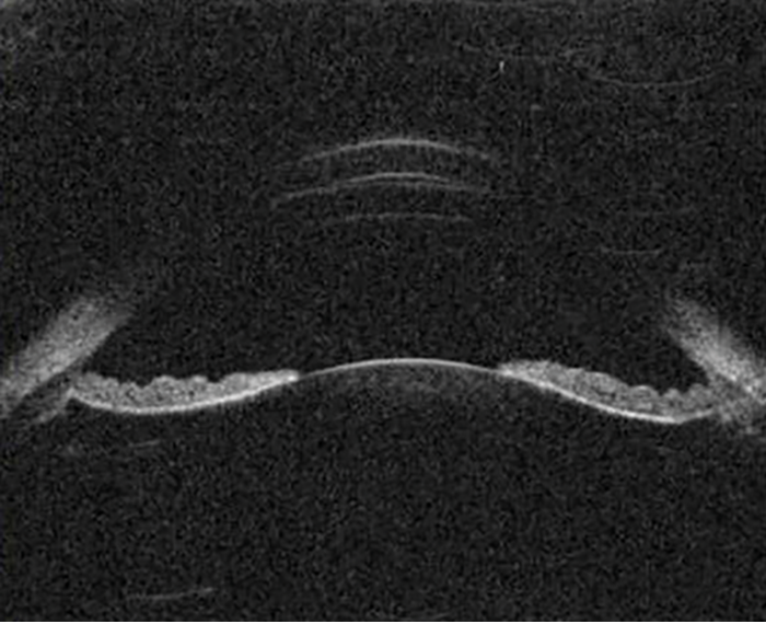 The interpretation and use of ultrasound biomicroscopy (part 1) | Eye News
