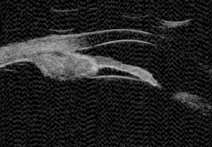 The interpretation and use of ultrasound biomicroscopy (part 1) | Eye News
