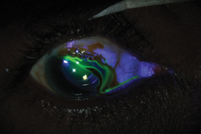 The approach to trabeculectomy postoperative complications | Eye News