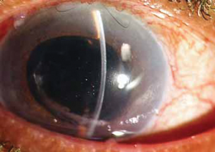 The approach to trabeculectomy postoperative complications | Eye News