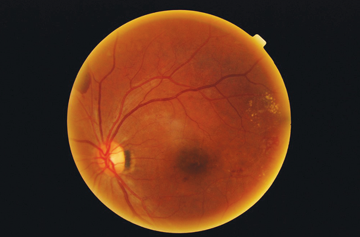 Fundus photography in Malawi – setting up a screening programmefor ...