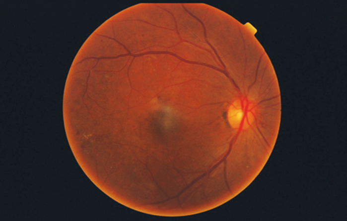 Fundus photography in Malawi – setting up a screening programmefor ...