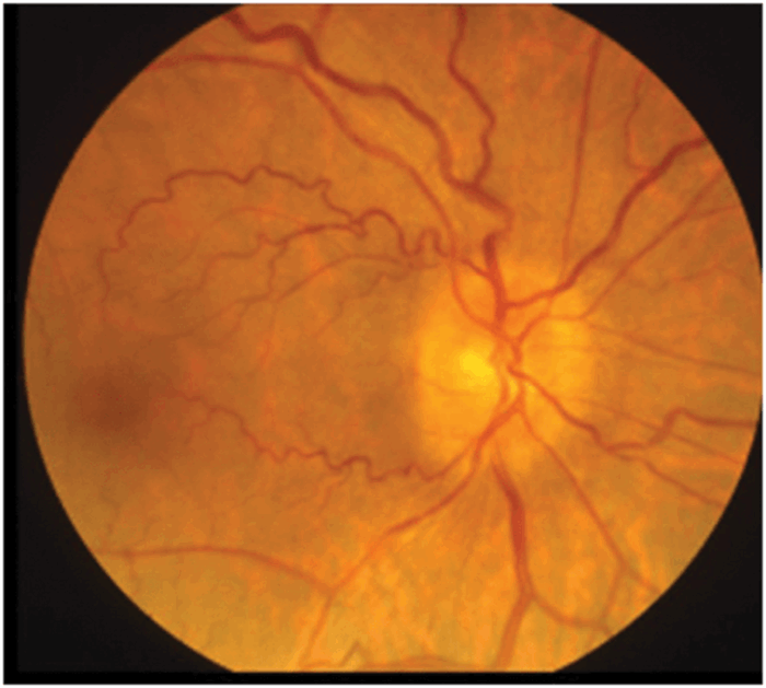Papilloedema: an update | Eye News