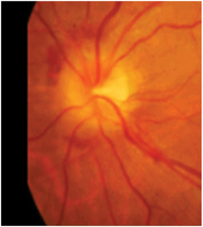 Papilloedema: an update | Eye News