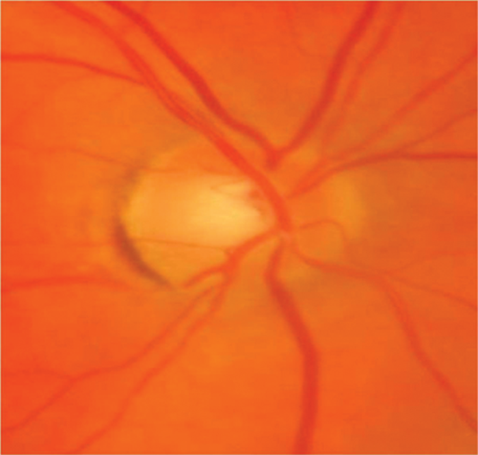 Typical and atypical optic neuritis – diagnosis and initial management ...