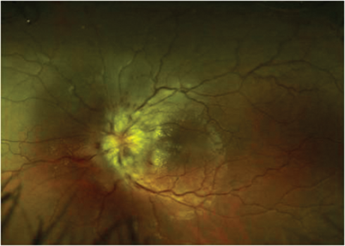 Typical and atypical optic neuritis – diagnosis and initial management ...