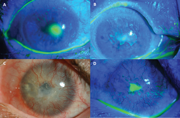 Resurfacing the ocular surface | Eye News