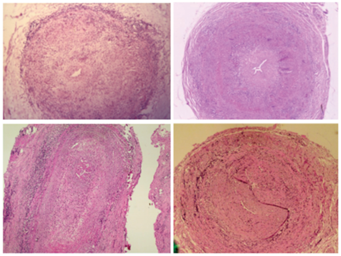 Neuro-ophthalmic disease patterns in Southeast Asia with particular ...