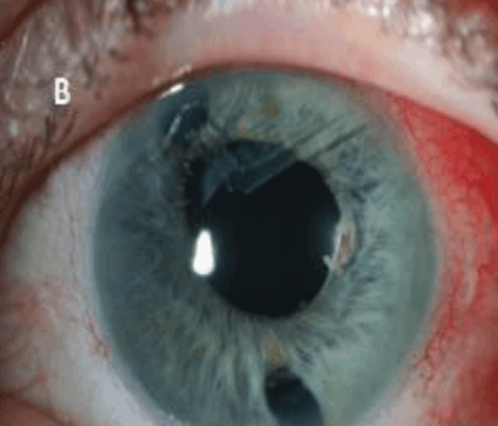 Bovine pericardium scleral patch graft associated scleritis: Ahmed ...