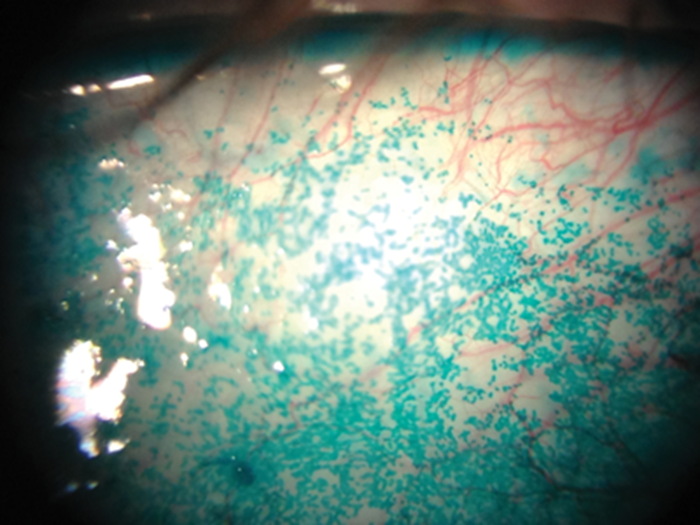 Optimising the ocular surface by managing meibomian gland dysfunction ...