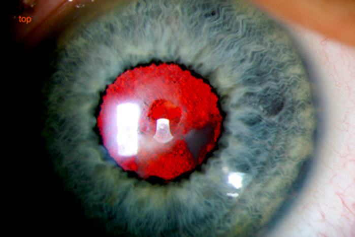 A refractive surprise after vitrectomy and capsulectomy | Eye News